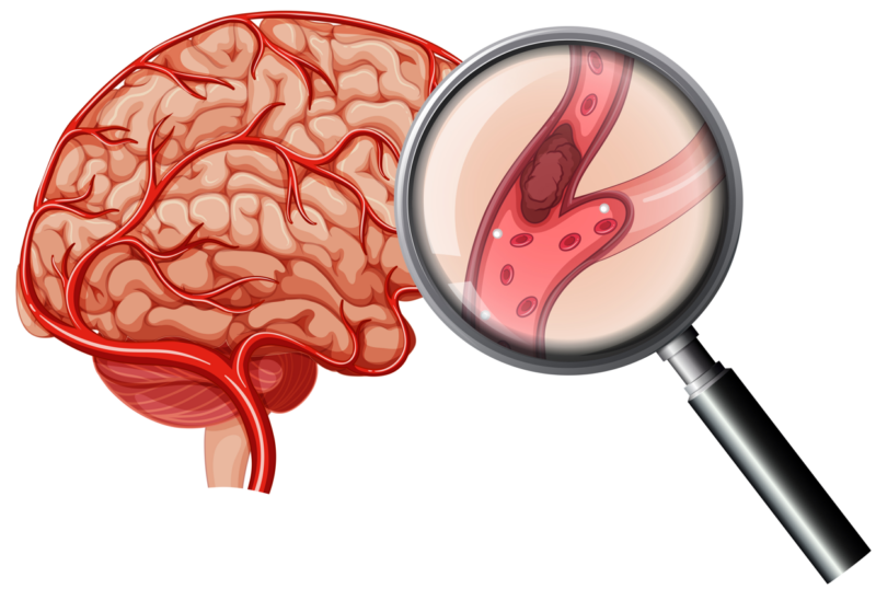 About aphasia – Australian Aphasia Association